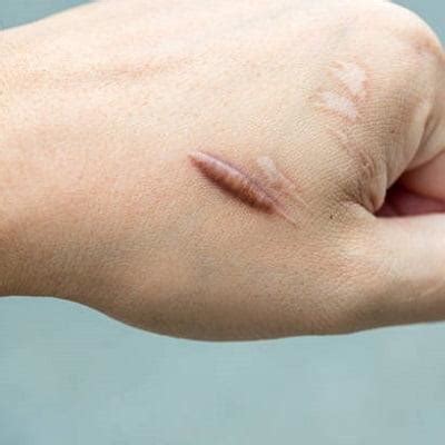 Keloid Treatment In Islamabad Pakistan