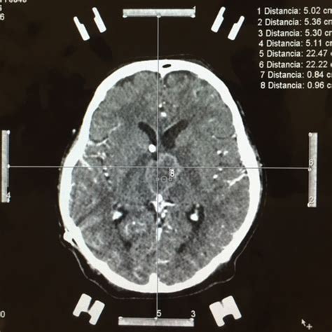 Stereotactic Biopsy With Zd Frame Contrastenhanced Cat Image Showing A Download Scientific