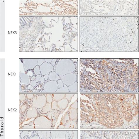 Immunohistochemistry Tissue Microarray Tma Of Specimens Of Human