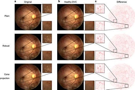 figure 2 from generating realistic counterfactuals for retinal fundus