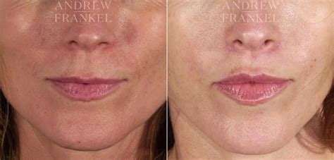 Lip Lift Recovery Day By Day Guide