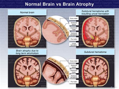 Normal Anatomy Vs Brain Atrophy TrialExhibits Inc