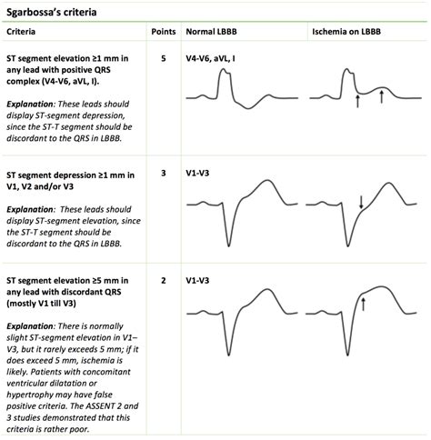 Table 1 Sgarbossa S Criteria Ecg Learning