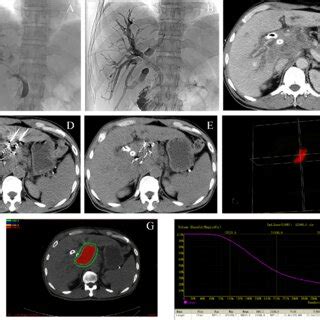 A 47 Year Old Male Patient With Cholangiocarcinoma Received SEMS Download Scientific Diagram