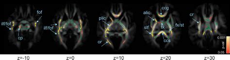 Figure 1 From In High Risk Preterm Infants White Matter Injury And