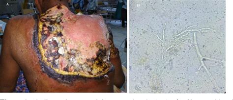 Figure 1 From A Rare Case Of Apophysomyces Variabilis Skin And Soft
