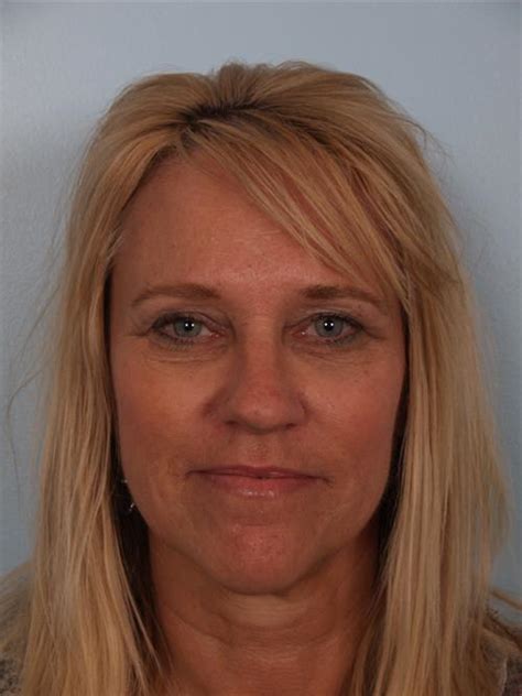 Eyelid Surgery Scottsdale Center For Plastic Surgery