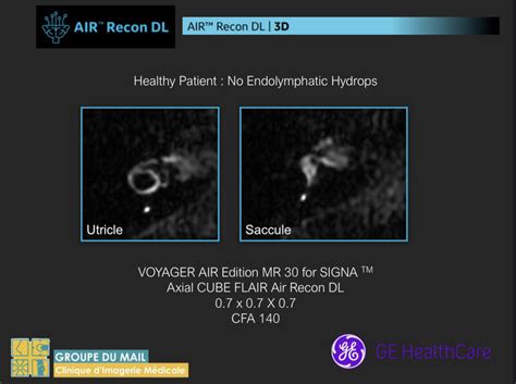 bastien perez on linkedin mr imaging of endolymphatic hydrops in