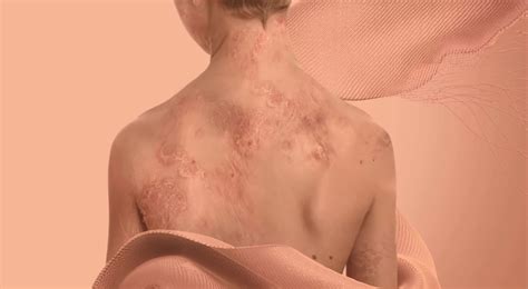 Copper Skin Vml