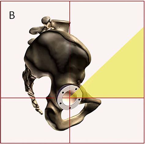 Pdf Trigonometric Algorithm Defining The True Three Dimensional Acetabular Cup Orientation