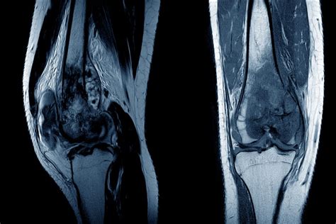 Osteosarcoma Knee