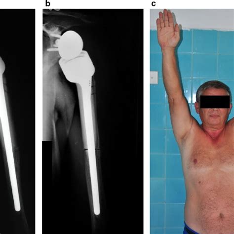 A Reconstruction Of The Left Proximal Humerus Due To A Chondrosarcoma