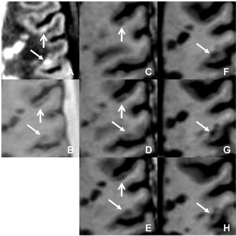 3d Mprage Improves Classification Of Cortical Lesions In Multiple Sclerosis Pmc