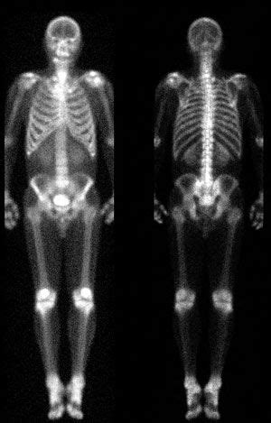Nm Bone Scan Whole Body Cpt Code