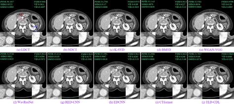 Figure 1 From Image Denoising For Low Dose Ct Via Convolutional