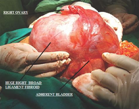 Huge 9 Kg Broad Ligament Fibroid Mimicking Sarcoma Of Uterus A Case Report And Review Of