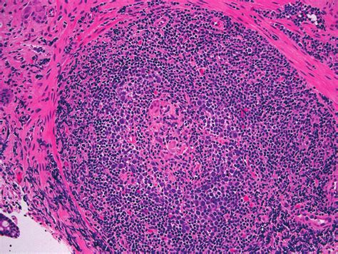 Crohns Disease Noncaseating Granulomas Quotes Trendy New