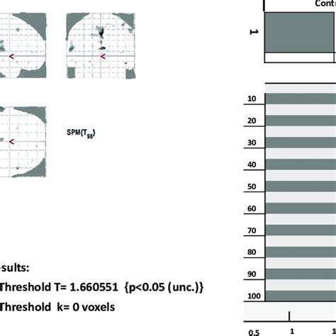 Glass Brain View Of Alzheimers Disease Brain At Mci Spm Output Download Scientific Diagram