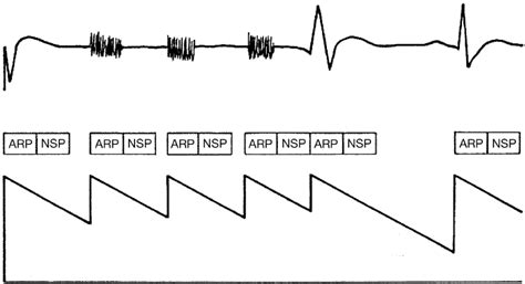 The Effect Of Continuous Interference The Ecg Upper Panel Download Scientific Diagram