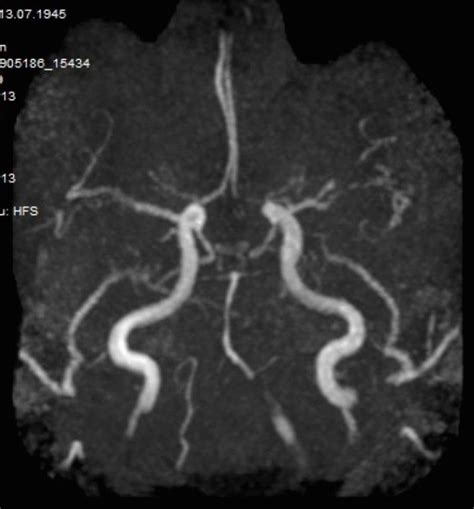 Magnetic Resonance Angiography Images Showes Right Hypoplastic