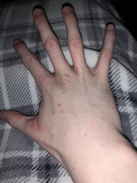 Is This Scabies Help I Just Cant Stop Itching R Scabies