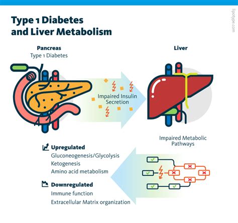 Type 1 Diabetes Diagram Pancreas