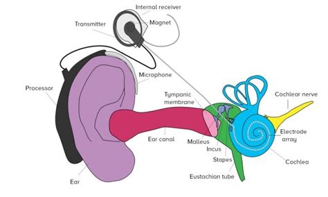What Do Cochlear Implants And Hearing Aids Sound Like Best Diagram Collection
