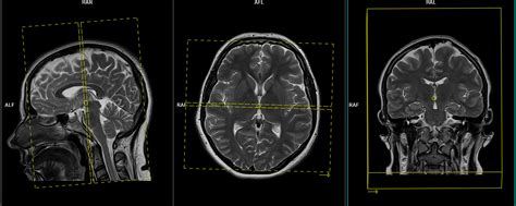 Cerebrospinal Fluid Flow Mri Csf Flow Mri Protocol And Planning