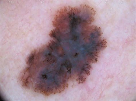 Superficial Spreading Melanoma With Breslow 05 Mm Located On The