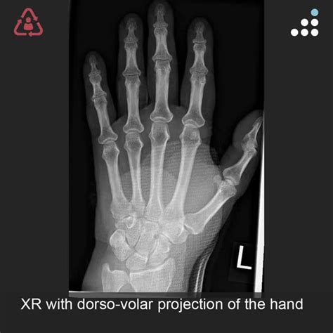 [video] Orthobullets On Linkedin Capitate And Scaphoid Fracture In 55f