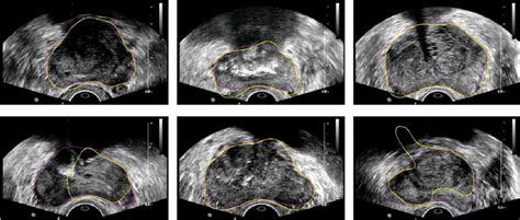 Example Segmentation Results Of The Prostate From Ultrasound Images Download Scientific Diagram