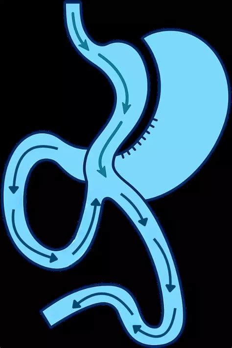 Loop Gastric Bypass Surgery