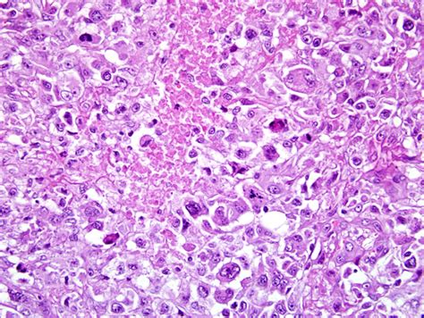 Histiocytic Sarcoma Of The Skin