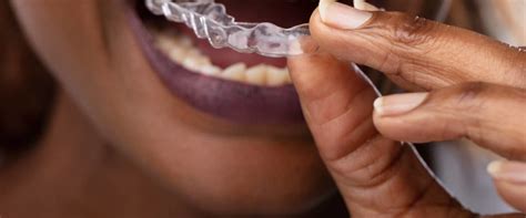 How Spark Aligners Can Complement And Enhance The Results Of Aesthetic Surgery In London