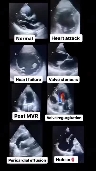 Smartmedicine Echocardiogram Heart Myocardial Hypokinesis