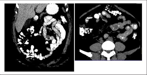 Figure 3 From Inflammatory Polyp Of The Ileum Causing Small Bowel Intussusception A Case Report
