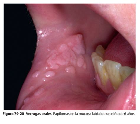 Verrugas En La Lengua