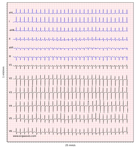 What Is Atrial Flutter With Variable A V Block At Jackson Dunrossil Blog