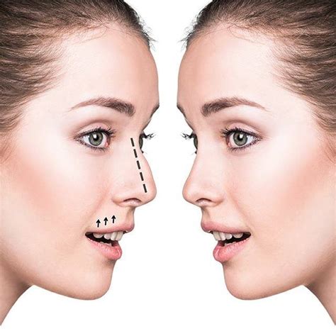 ცხვირის ოპერაცია რინოპლასტიკა