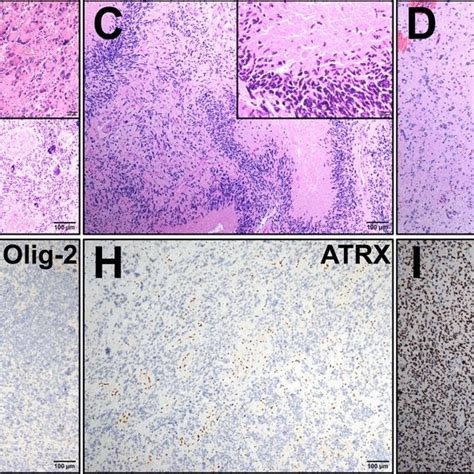 Histological Analysis Of Diffuse Hemispheric Glioma H G Mutant Download Scientific Diagram