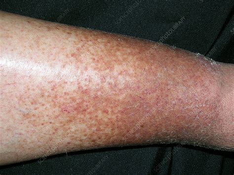 Pigmented Purpuric Dermatosis Stock Image C0565138 Science Photo