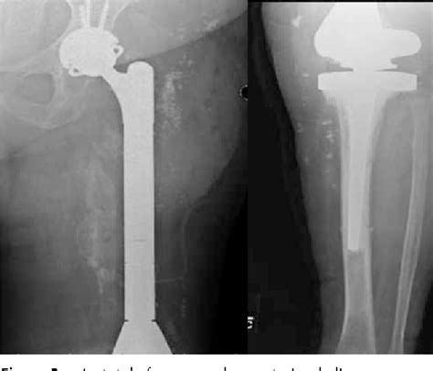 Figure 1 From Mating Of A Prostalac Spacer With An Intramedullary Nail For Reconstruction Of An