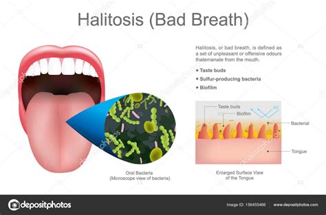 Halitosis Bad Breath Education Info Graphic Vector Design Stock Vector Pattarawit