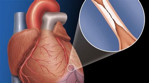 Arteriosklerose Stadien Behandlung Und Parthogenese