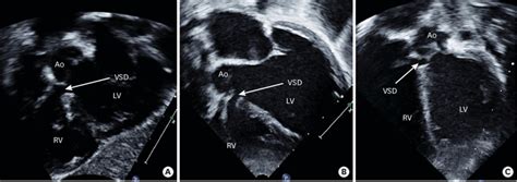 Type A Vsd Perimembranous Vsd Shown In Subxiphoid Short Axis View A Download Scientific