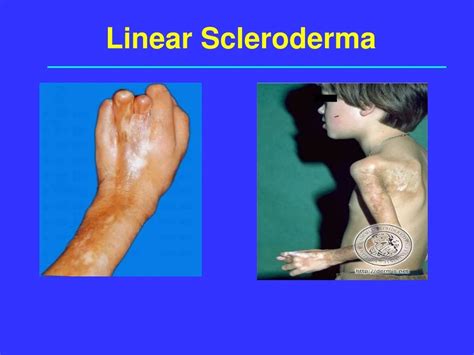 Ppt Scleroderma Symptoms Diagnosis And Management Powerpoint