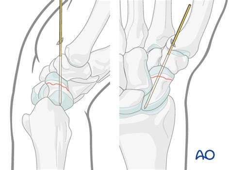 Percutaneous Screw Fixation Through A Palmar Approach For Scaphoid Waist Fracture