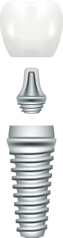 치과 임 플 란 트 구조 의료 그림 교육적인 Infographic 어 금 니 교체 끝 건강 도구 모델 흰색 배경에 고립 벡터