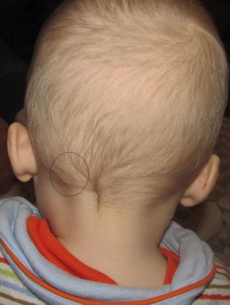 Inflamación De Los Ganglios Linfáticos En La Nuca Del Niño 18 Fotos