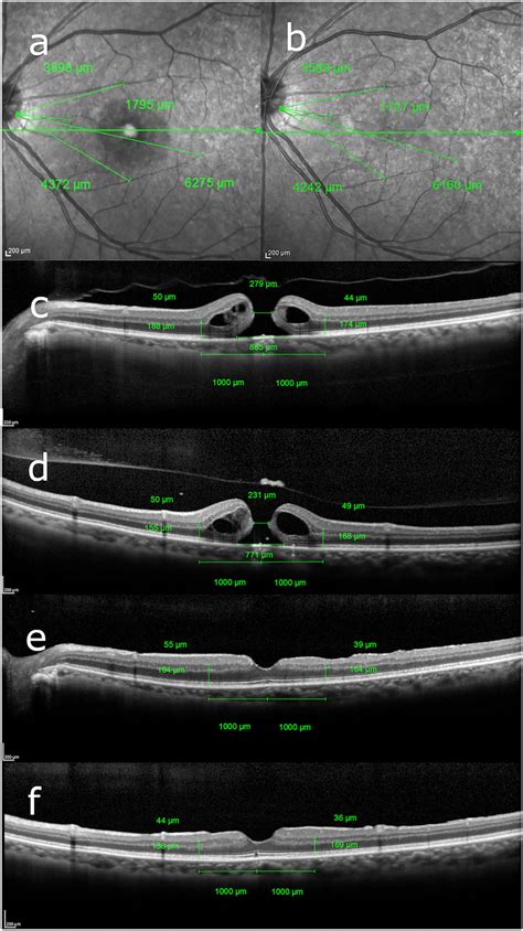 Measurement Of Optical Coherence Tomography Parameters In Macular Hole Download Scientific